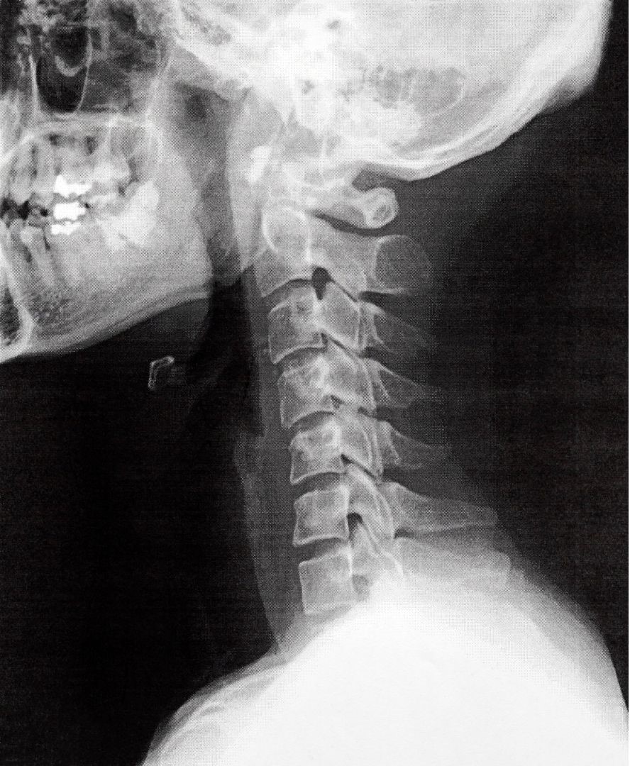 Understanding Cervical Kyphosis - Melville Osteopathy